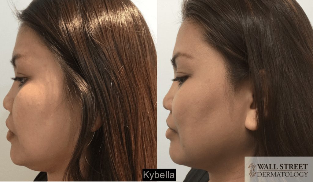 Kybella Injections - Wall Street Dermatology