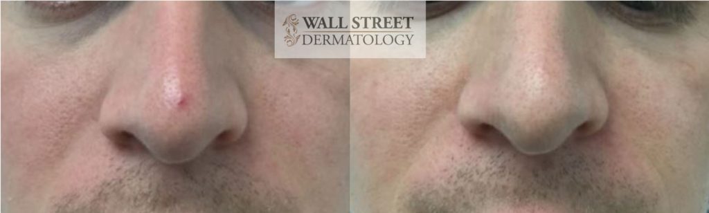 Laser Treatment - Wall Street Dermatology