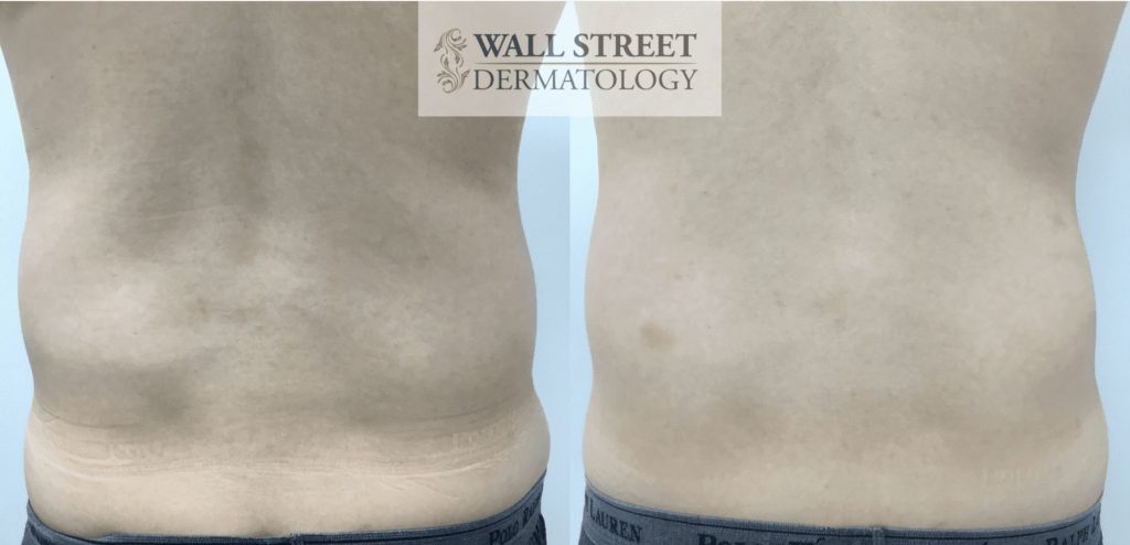 Kybella Injections - Wall Street Dermatology